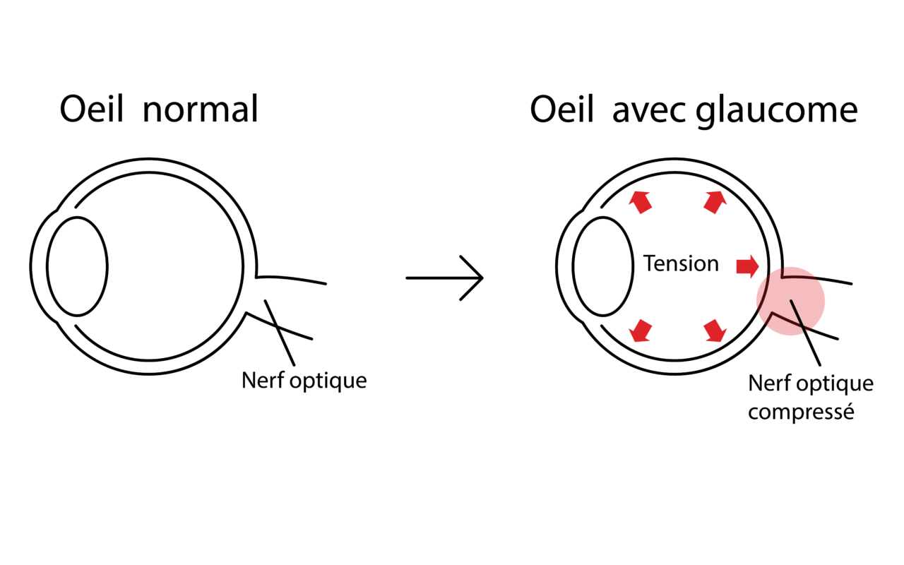 Traitement glaucome Caen - Dr Eva Grée